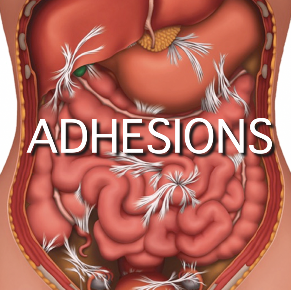 Abdominal Adhesions Due to Surgery - Innovative Therapy Canada.
